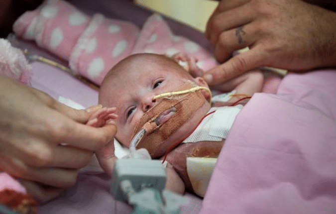 Operan con éxito a un bebé que nació con el corazón en el exterior de ...