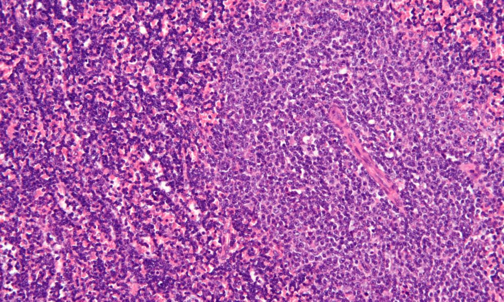 AVANCE| Científicos españoles descubren un gen causante de la leucemia ...